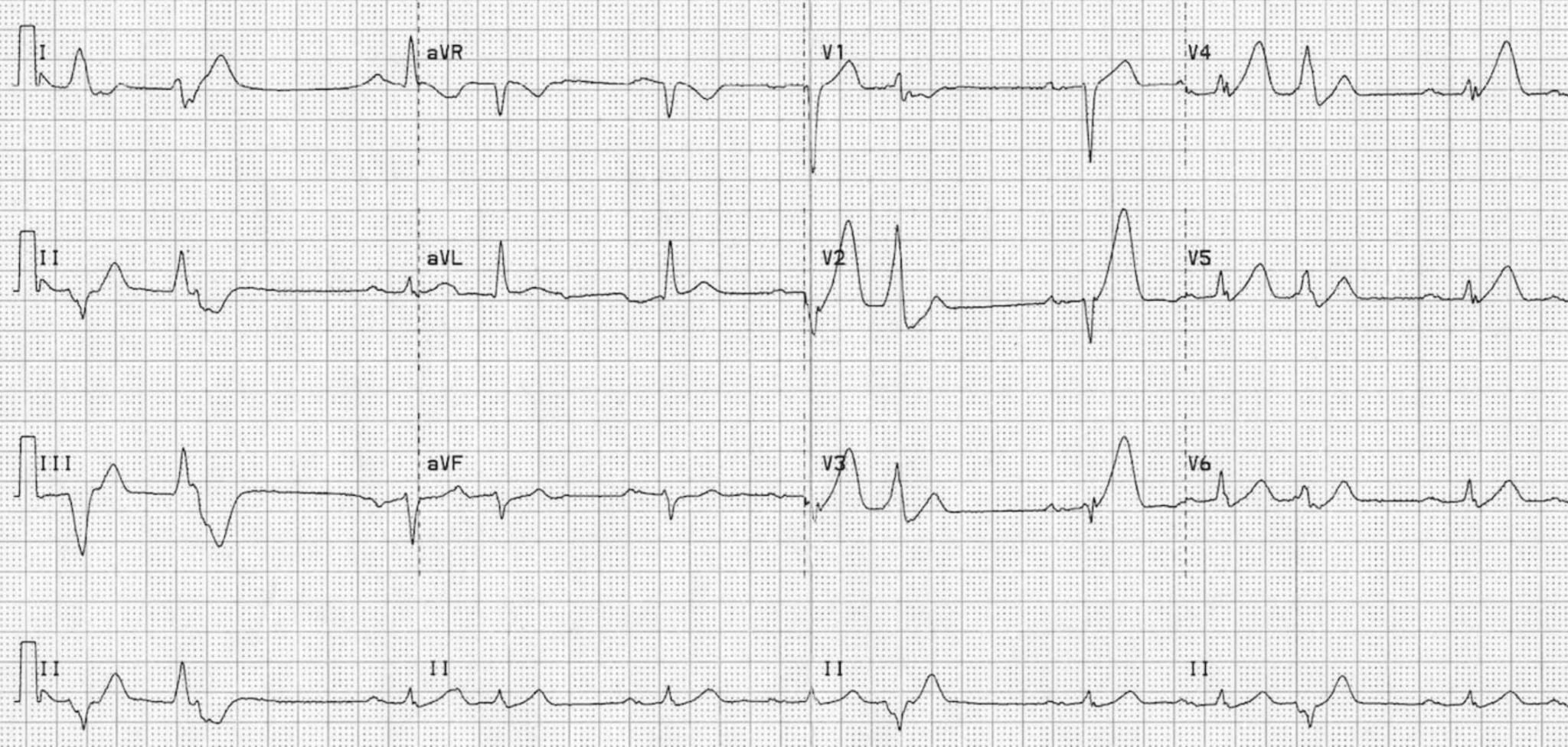 Infarctus du myocarde - Dr Synapse