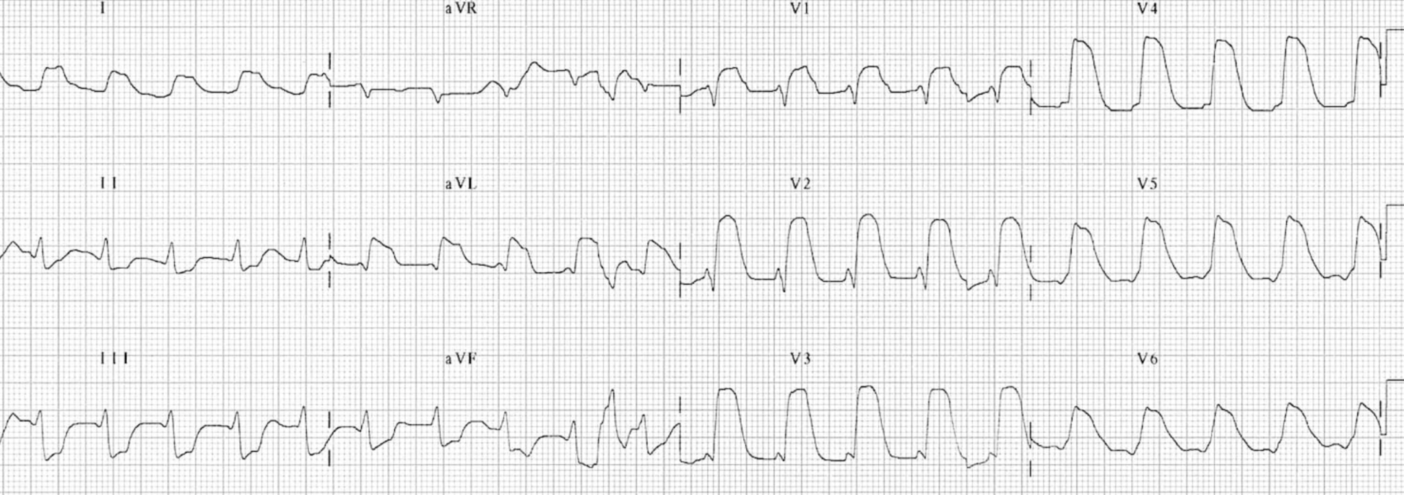 Infarctus du myocarde - Dr Synapse