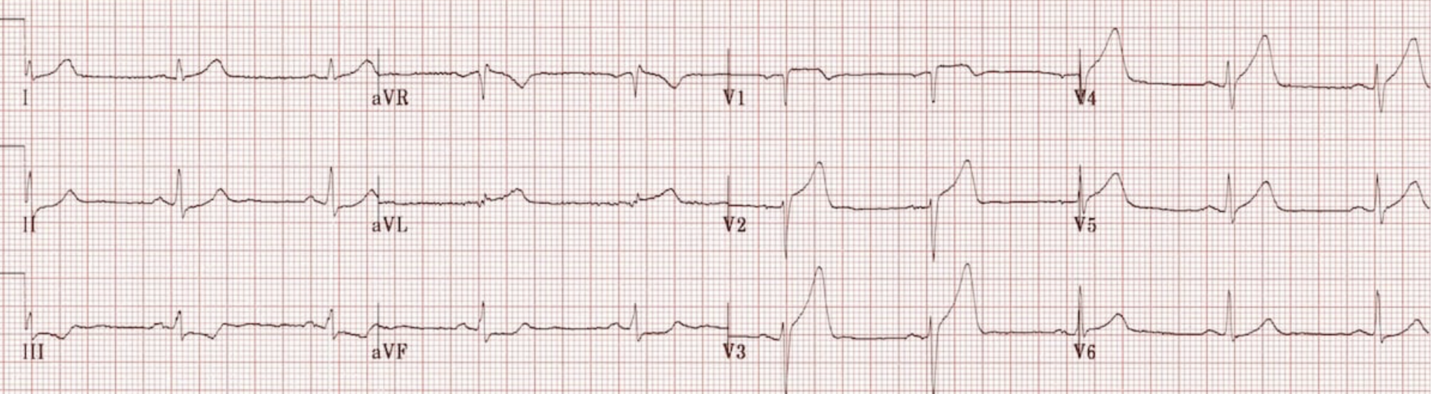 Infarctus du myocarde - Dr Synapse