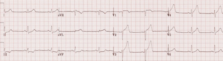 Infarctus du myocarde - Dr Synapse