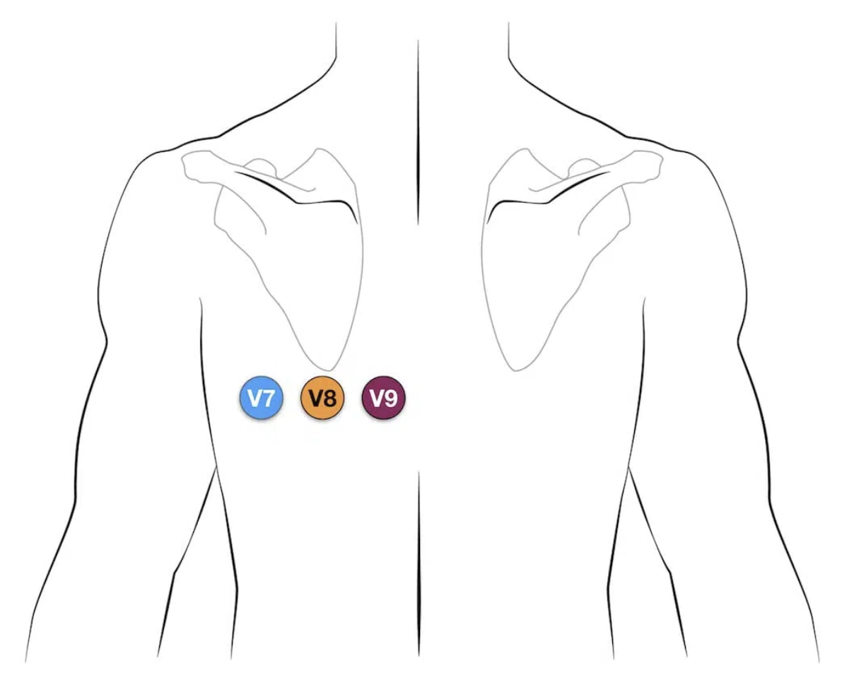 Infarctus du myocarde - Dr Synapse