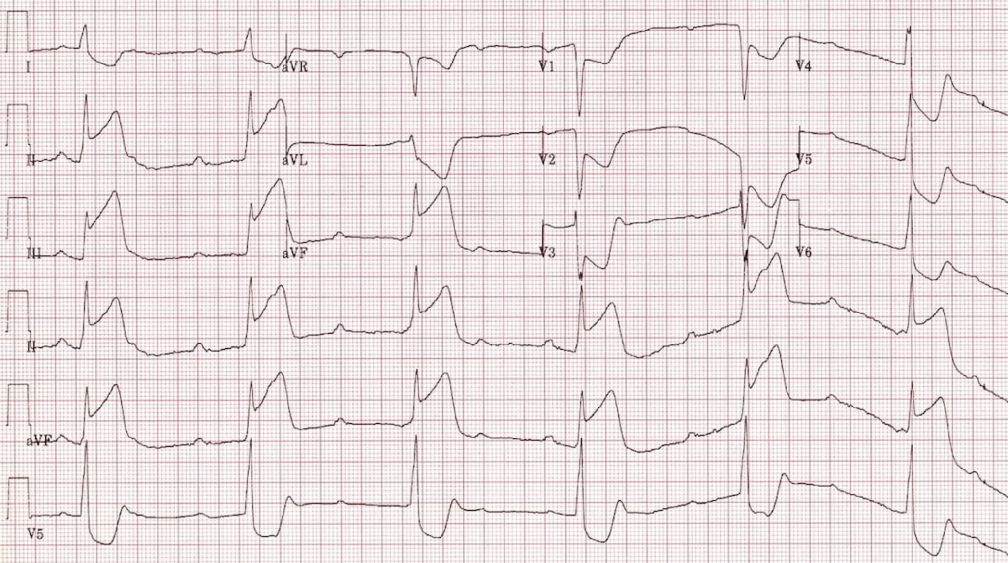 Infarctus du myocarde - Dr Synapse