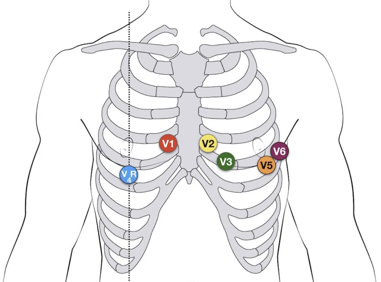 Infarctus du myocarde - Dr Synapse