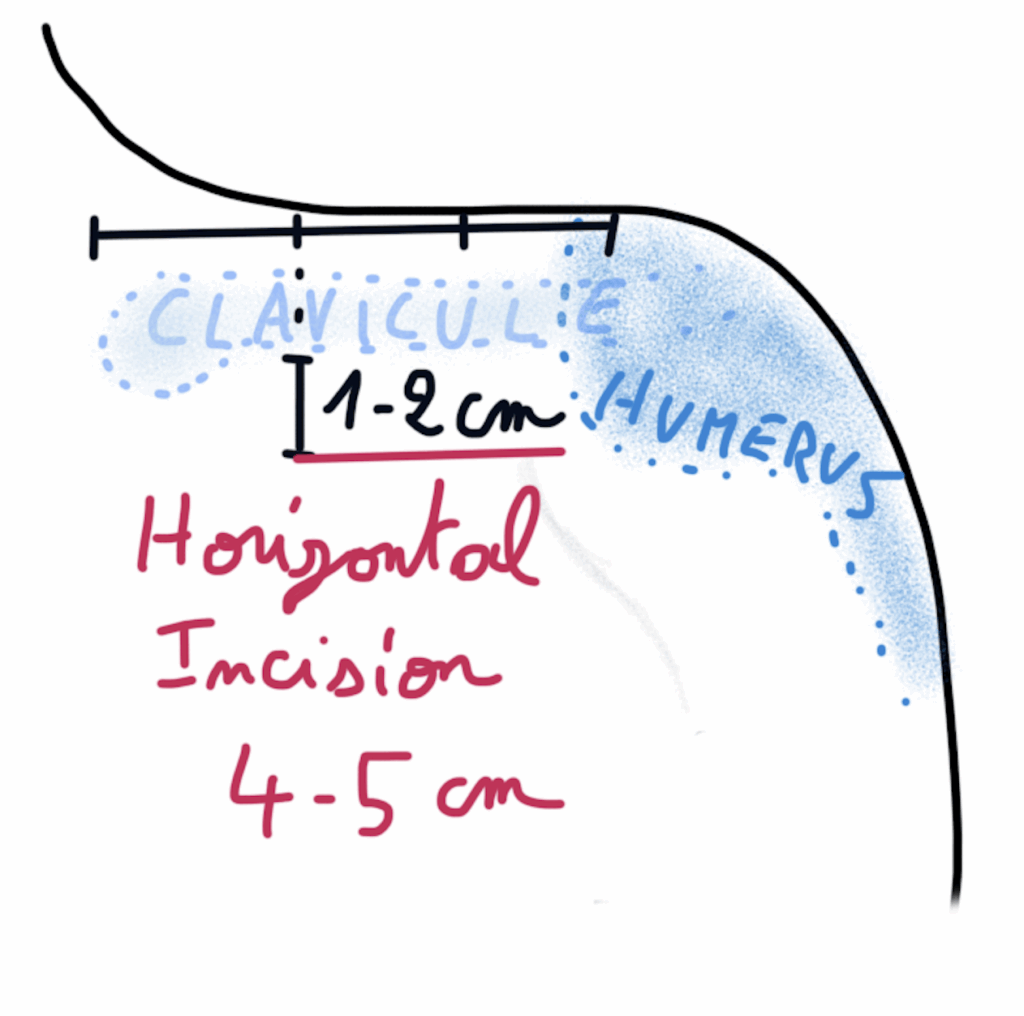 IV Pacemaker/ICD implantation step by step - Dr Synapse